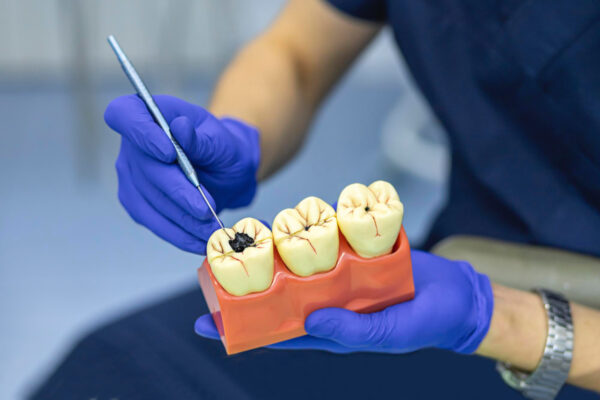 Dental Fillings